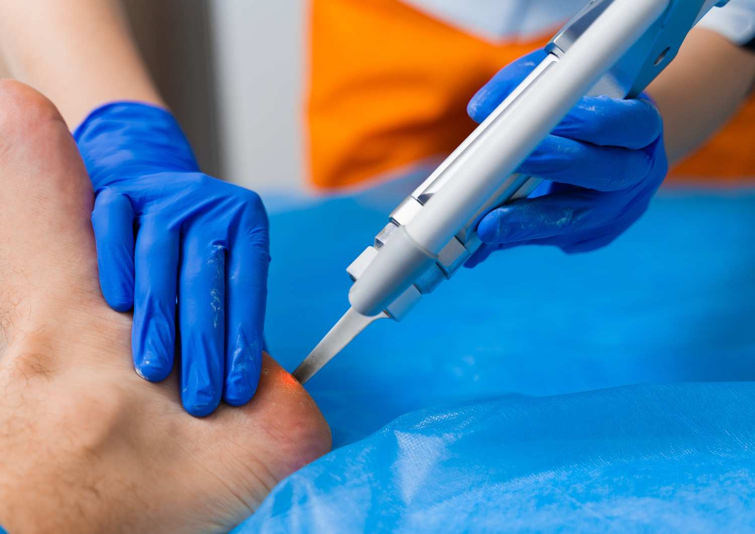 Laser CO2 pour le traitement des verrues plantaires | Dermatologie Chénieux